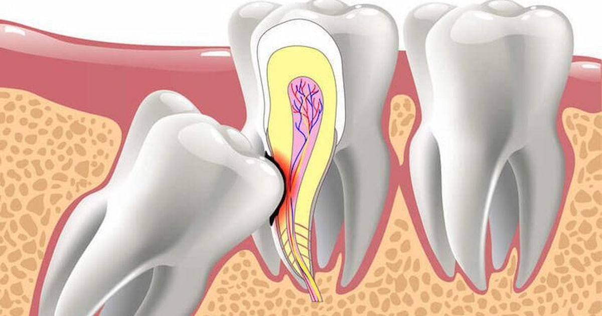 Wisdom Teeth Issues & Care | Dentistry on Gloucester